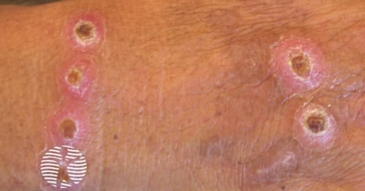 DermNet® - Thermal burn image