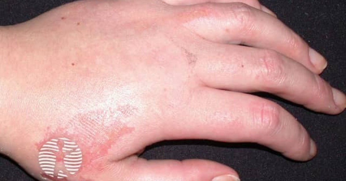 Chemical burns image