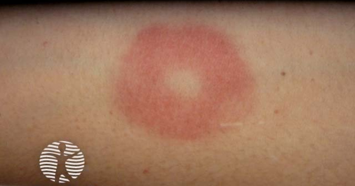 Urticaria induced by ice image