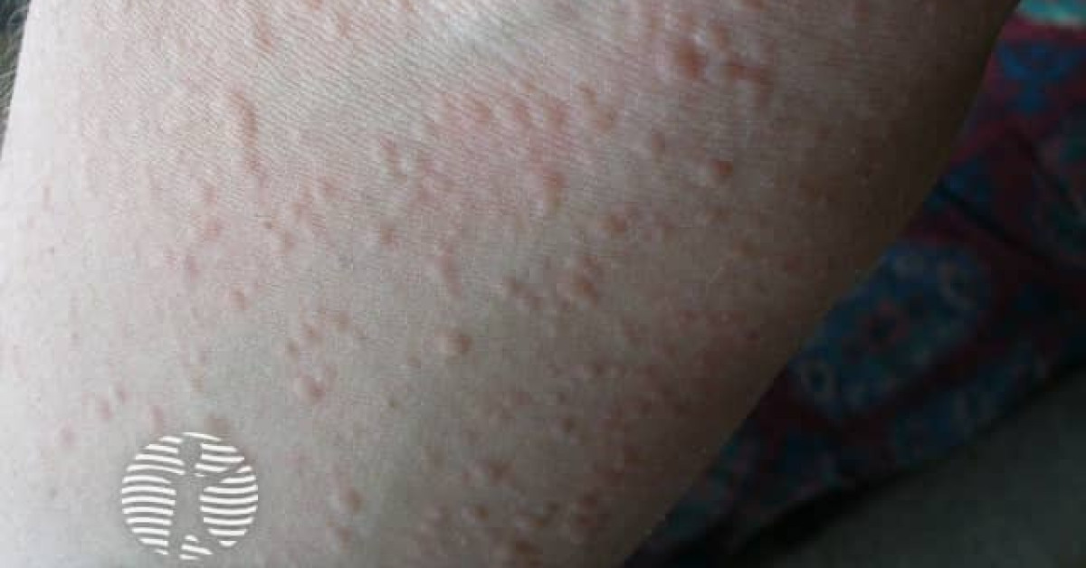 Cold Urticaria Image