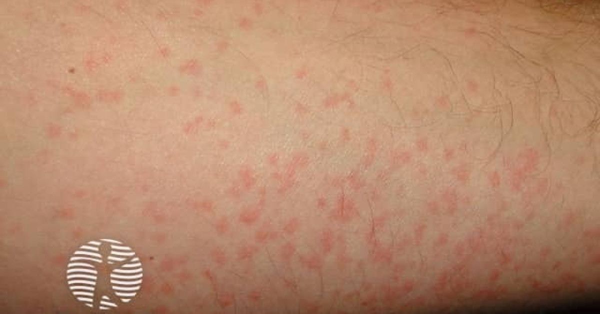 Cold urticaria image