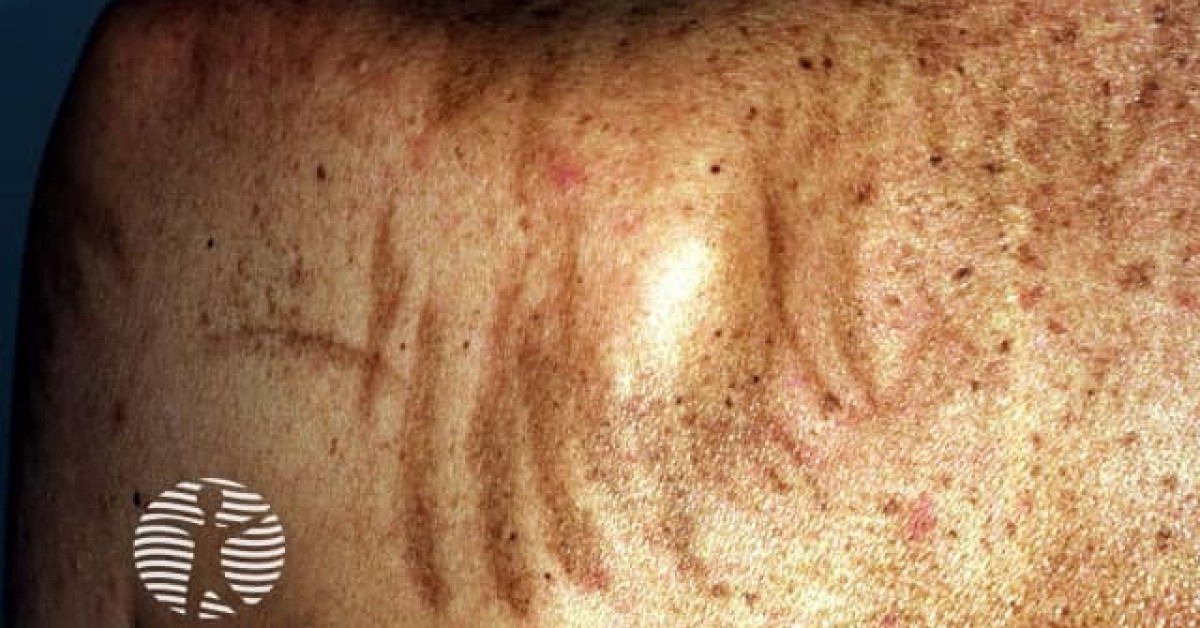 Pigmented streaks caused by bleomycin image