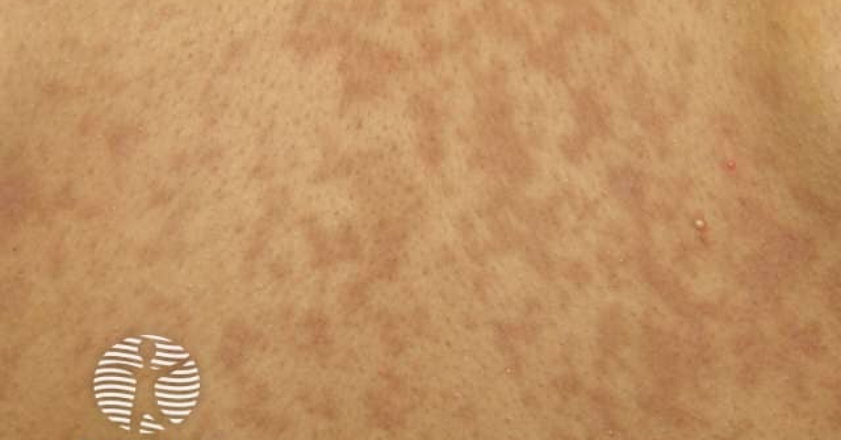 Dyspigmentation due to toxic epidermal necrolysis image