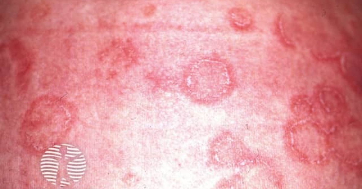 Erythema annulare centrifugum image
