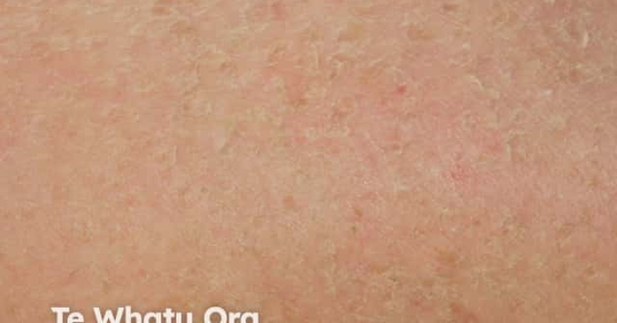 Dry skin due to vemurafenib image