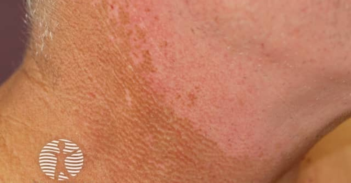 Leukoderma due to protein kinase inhibitor image