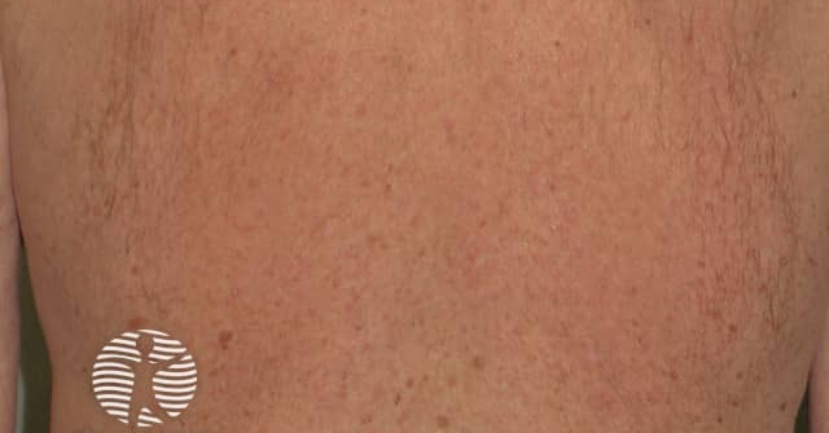 Rash due to vemurafenib image