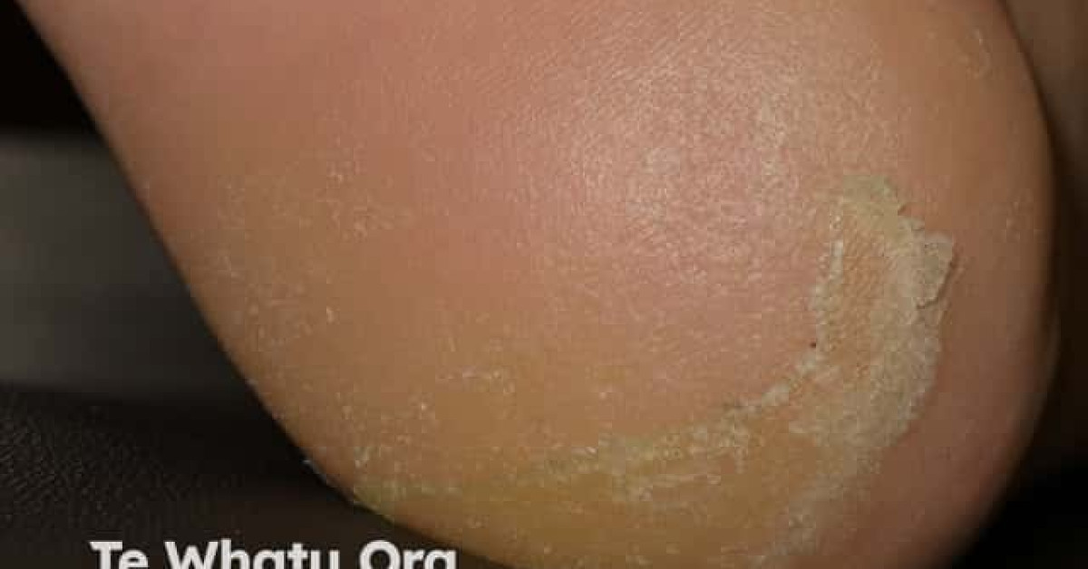 Keratoderma due to vemurafenib image