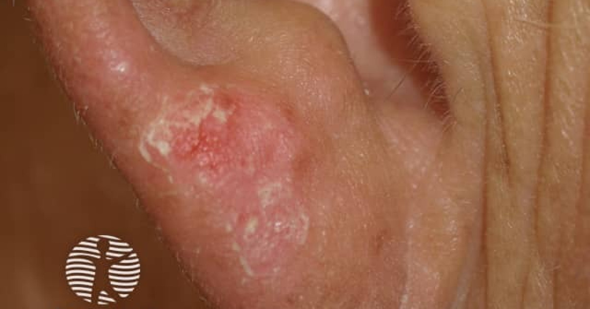 Sunburned earlobe following minimal sun exposure due to vemurafenib image