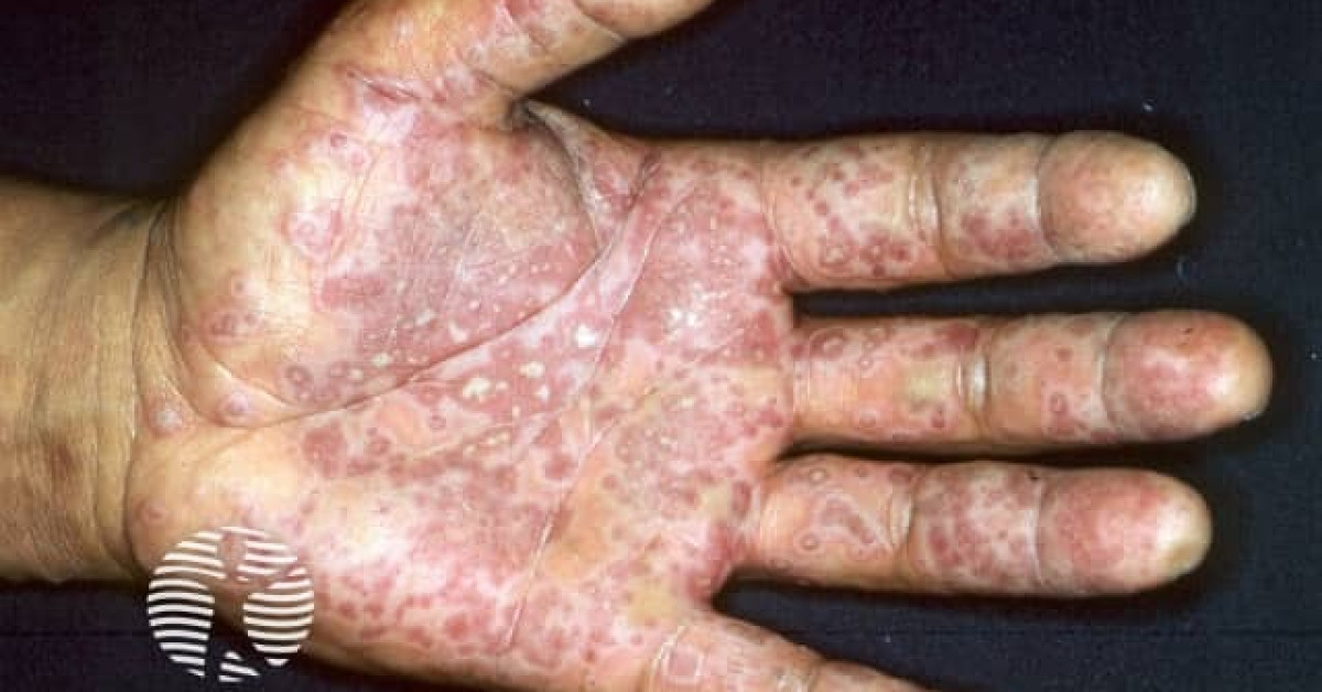 Erythema multiforme image