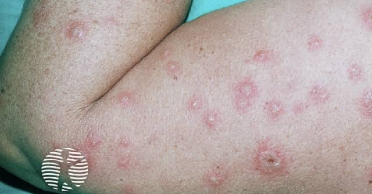 Erythema multiforme image