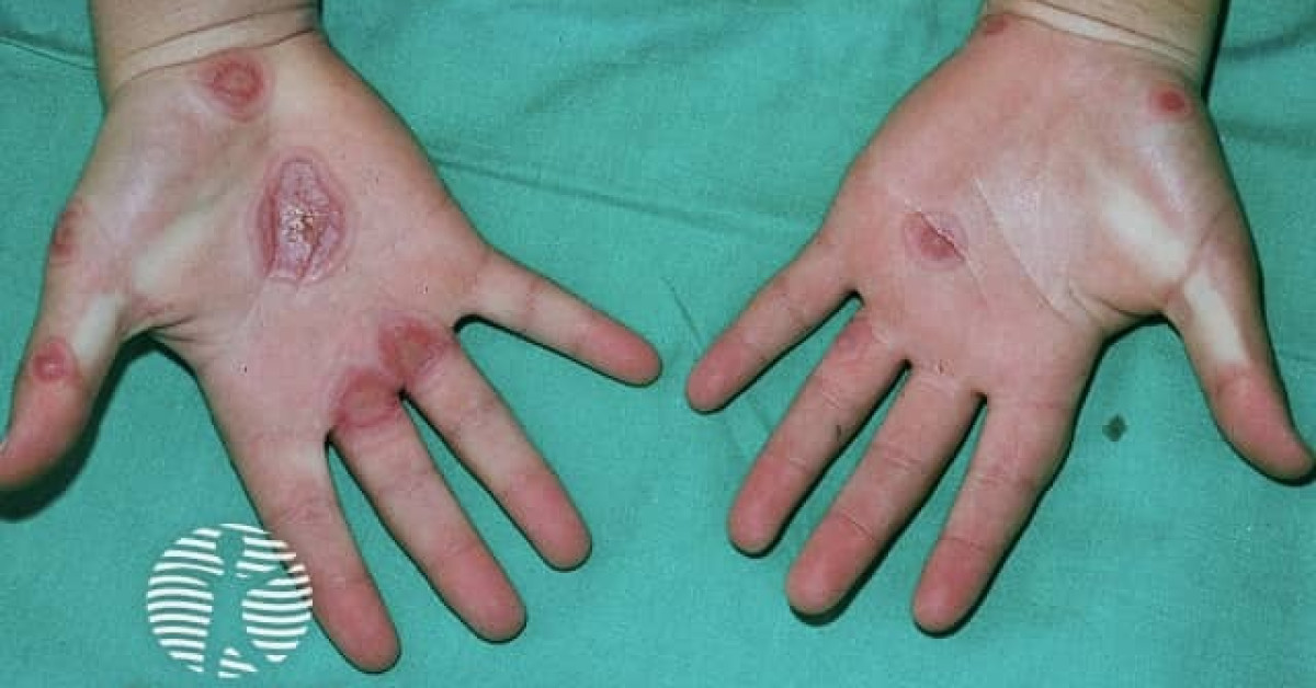 Erythema multiforme image
