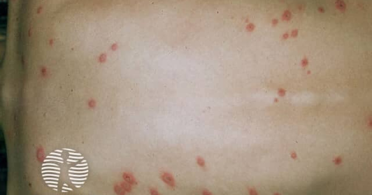 Erythema multiforme image