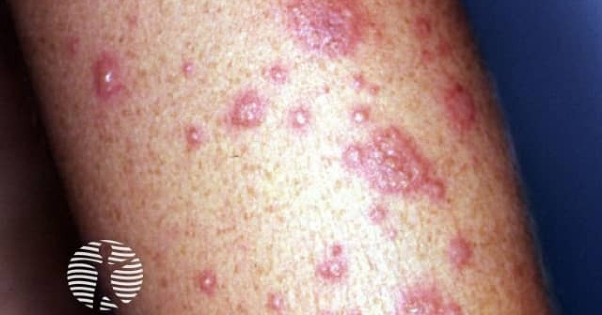 Erythema multiforme image