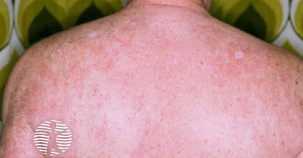 Erythroderma image