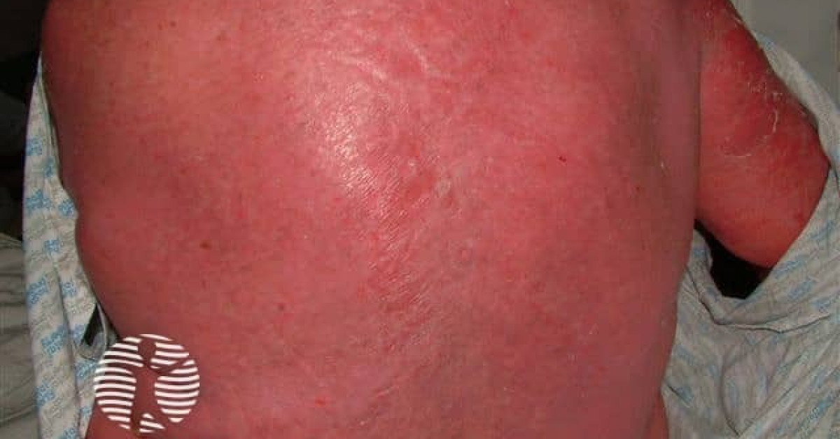 Erythroderma image