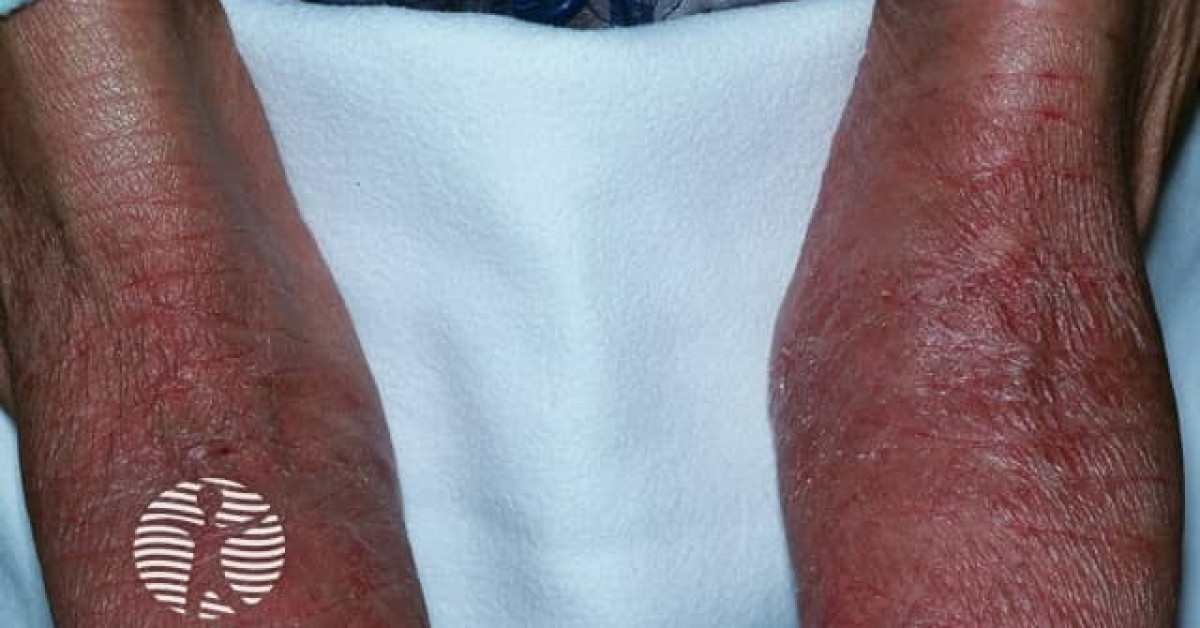 Erythroderma image