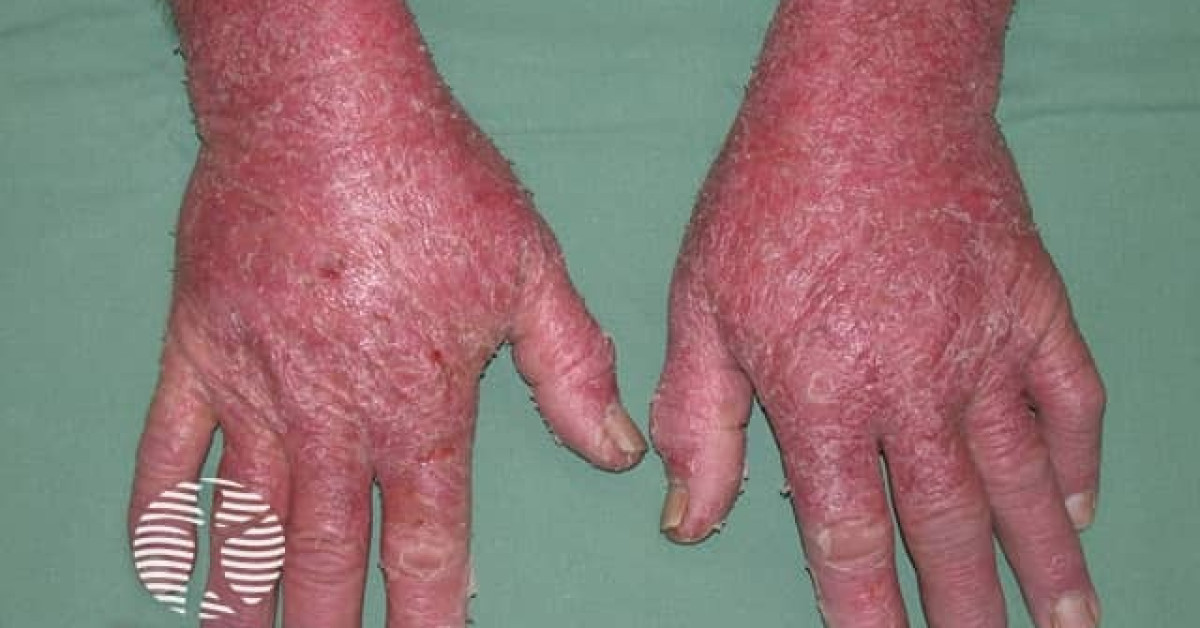Erythroderma image