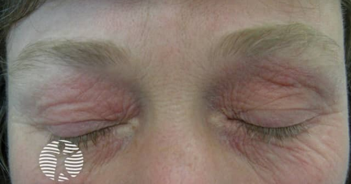 Hand dermatitis due to compositae allergy image