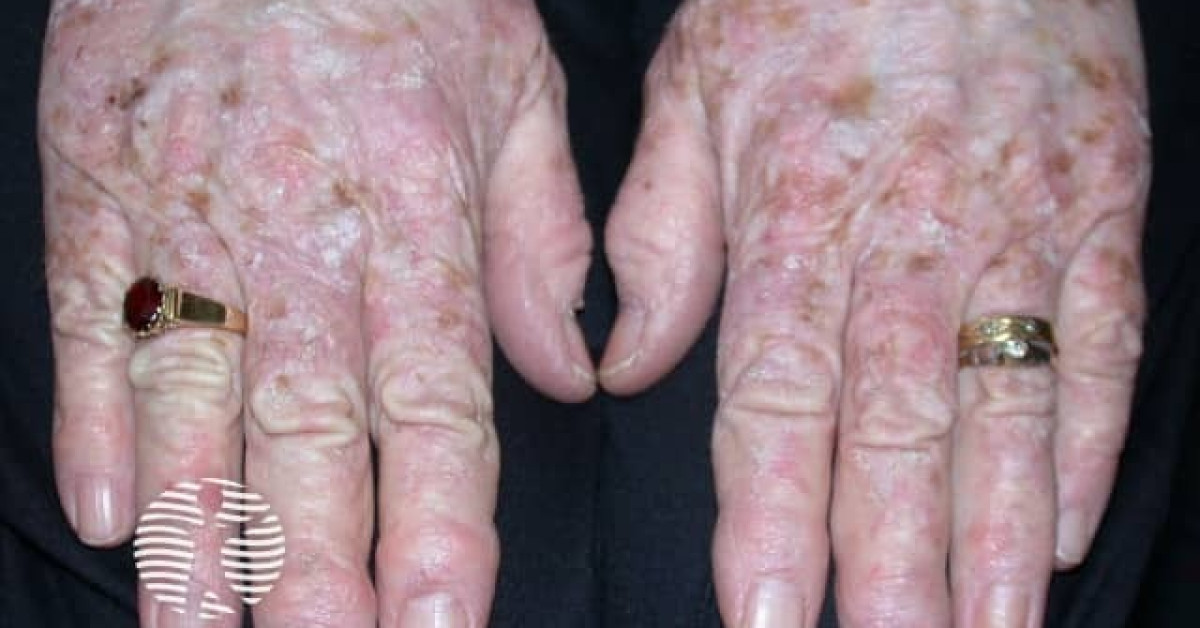 Sun damage: actinic keratoses image