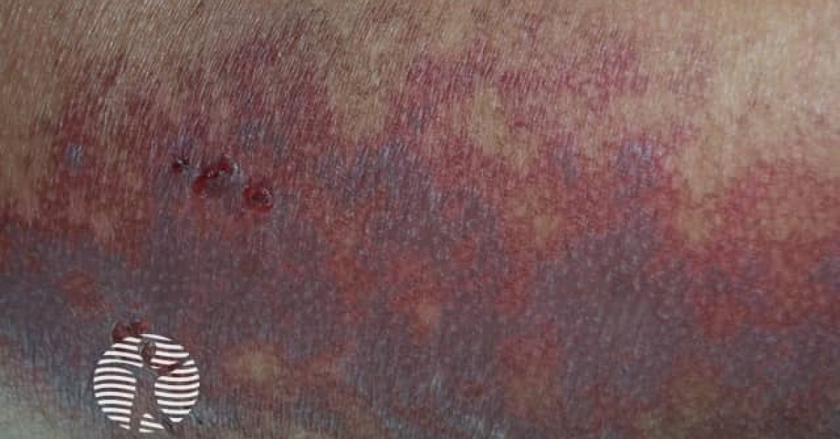 Fixed drug eruption image