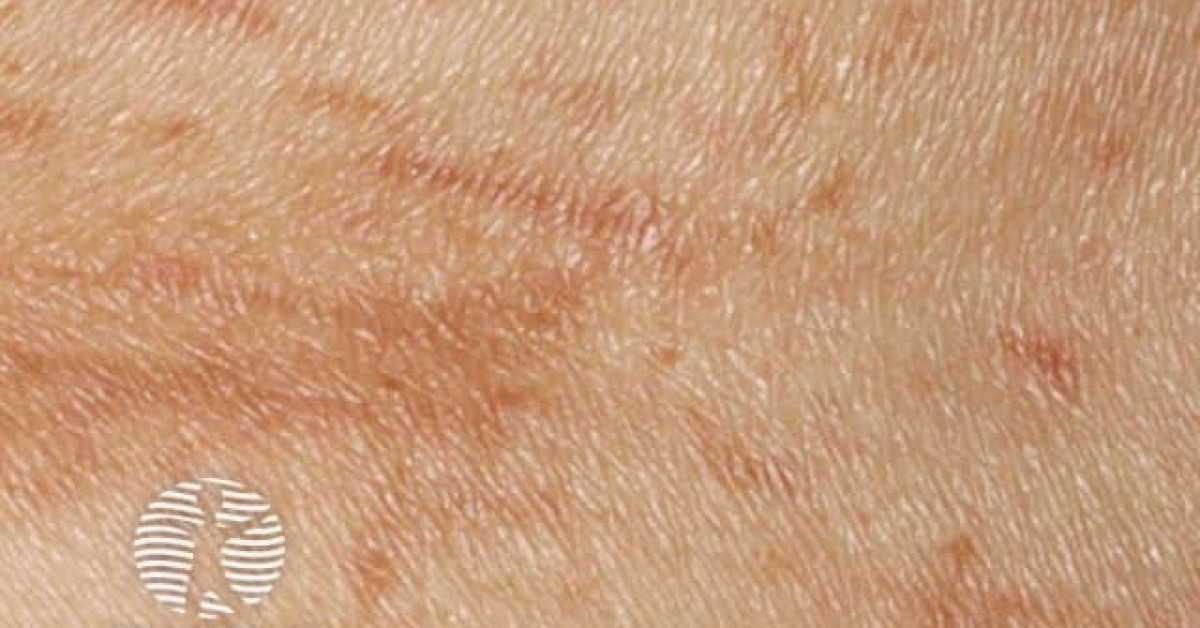 Flagellate erythema image