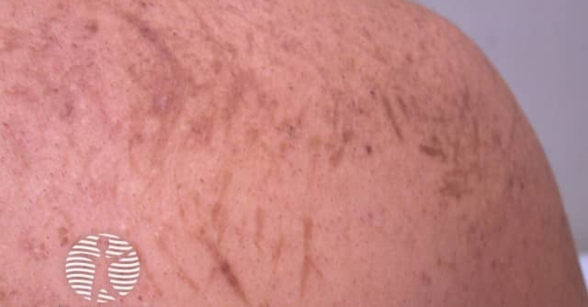 Flagellate erythema image