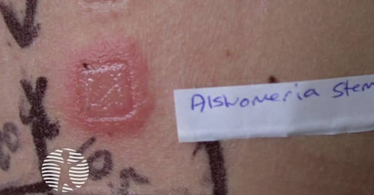 Plant contact dermatitis image