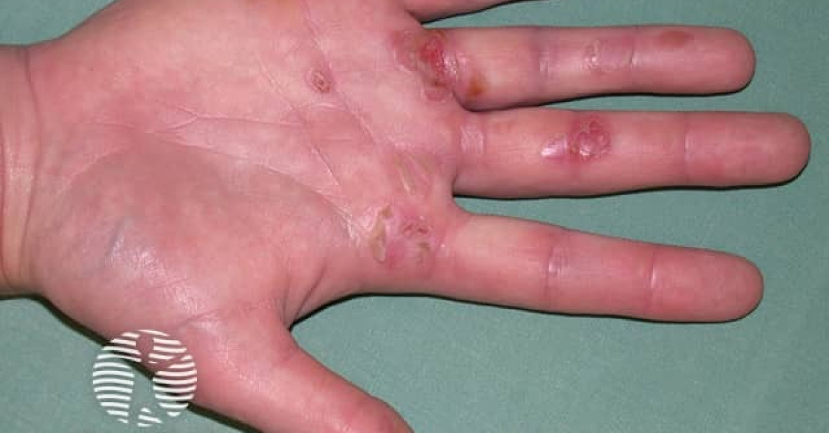 Friction blisters image
