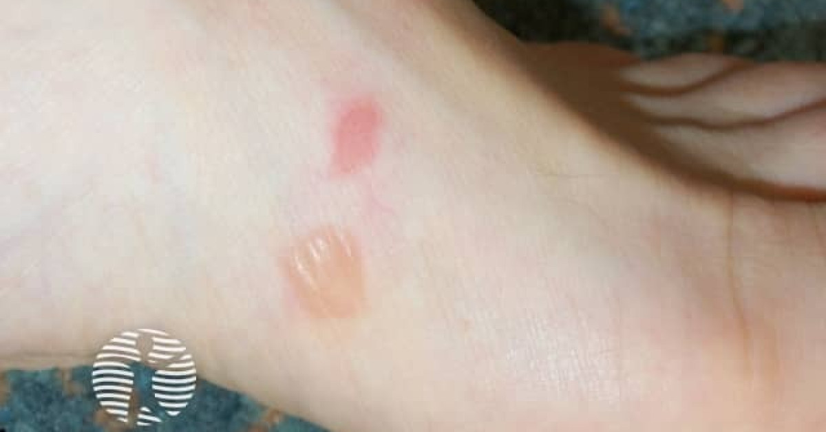 Friction blisters image