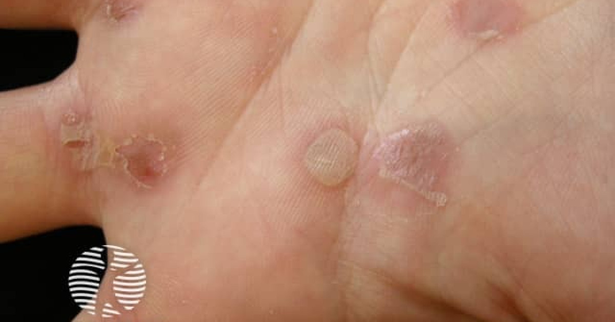 Friction blisters image