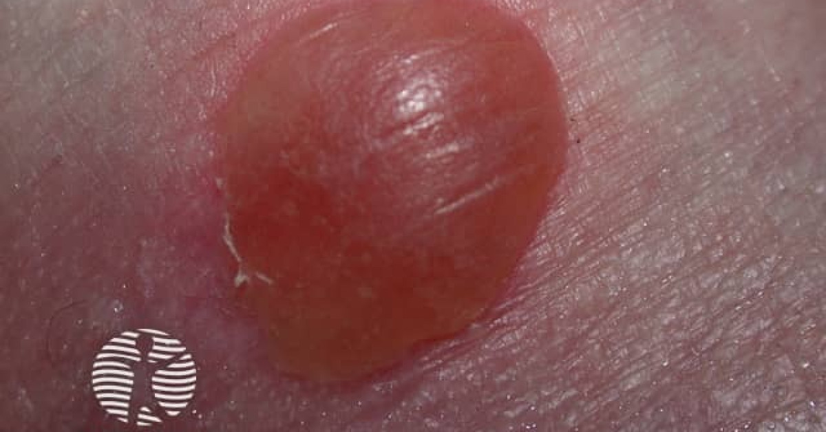 Friction blisters image