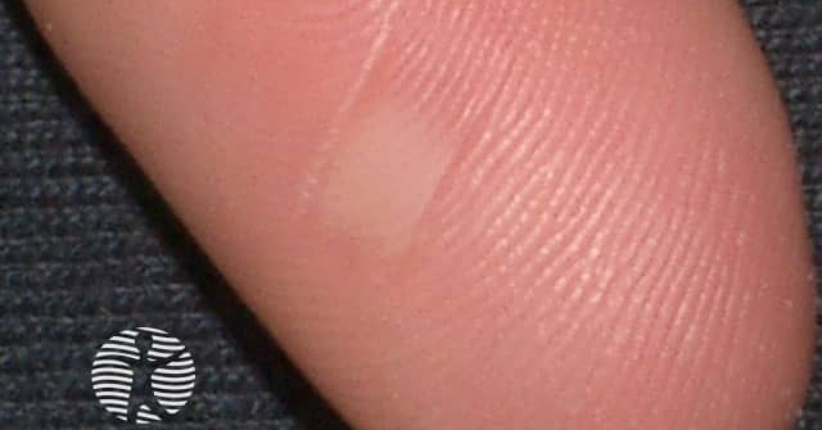 Friction blisters image