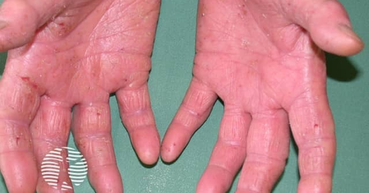 Hand dermatitis in hairdresser image