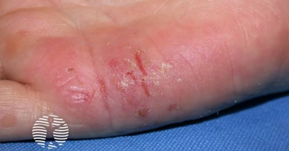 Hand dermatitis in hairdresser image
