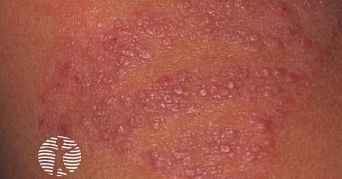 Black henna reaction image