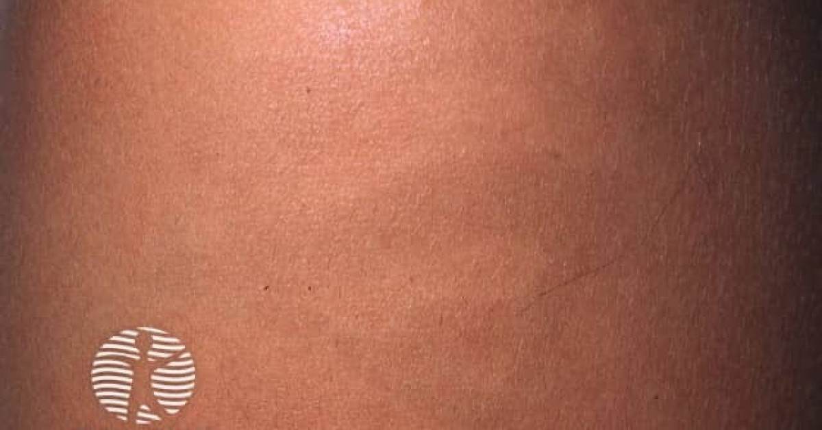 Black henna reaction leaving pigmentation image