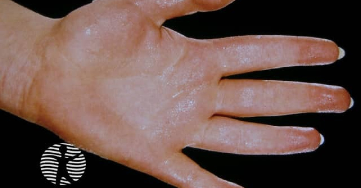 Palmar hyperhidrosis image