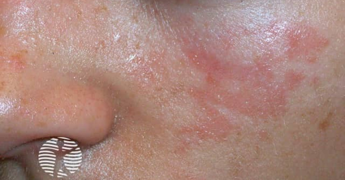 Irritant contact dermatitis image
