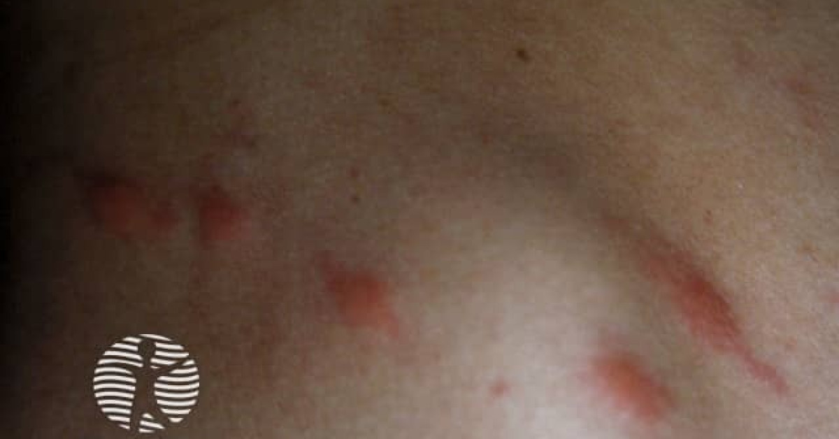 DermNet® - Insect bites image