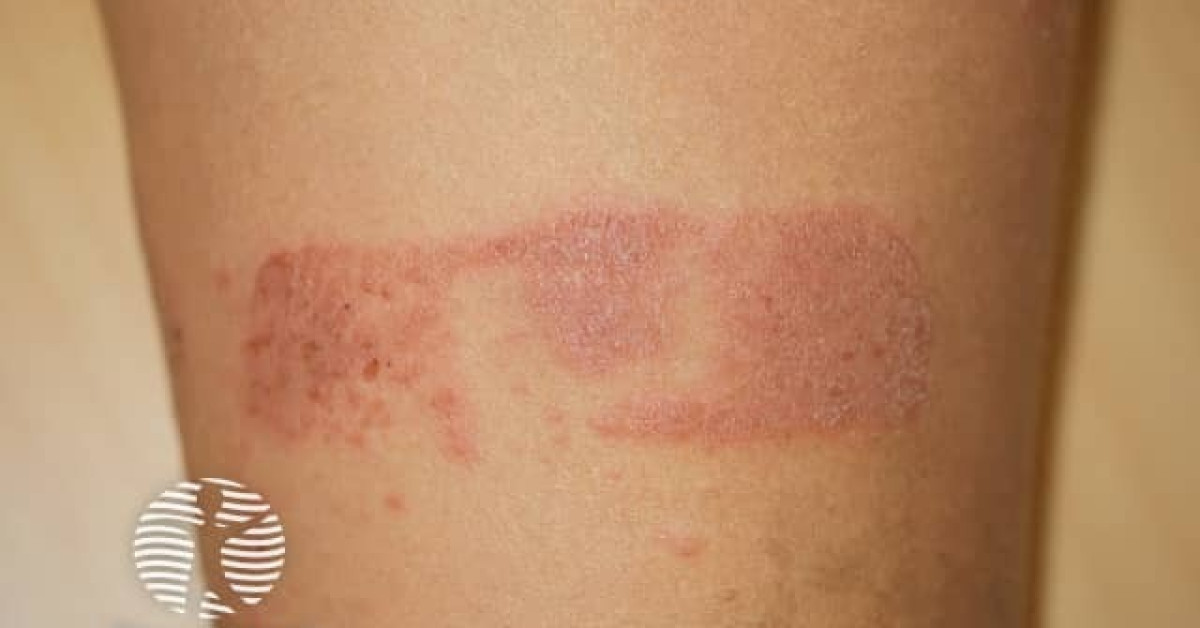 Koebner phenomenon in psoriasis due to contact dermatitis to adhesive ...