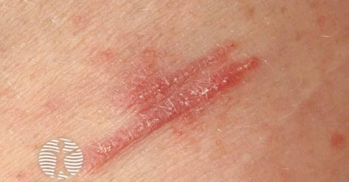 Linear lesions due to Koebner phenomenon in lichen planus image