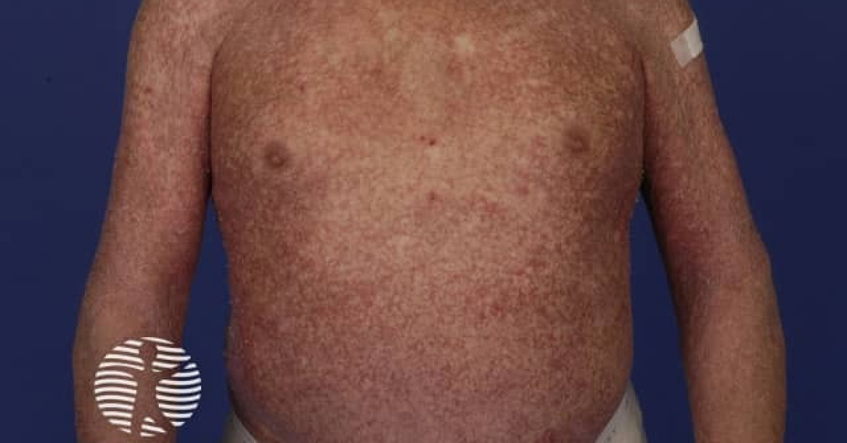 Lichenoid drug eruption image