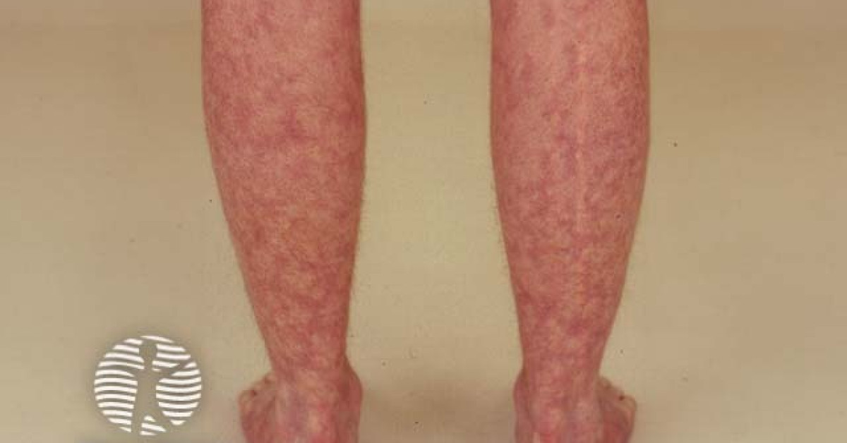Livedo reticularis image