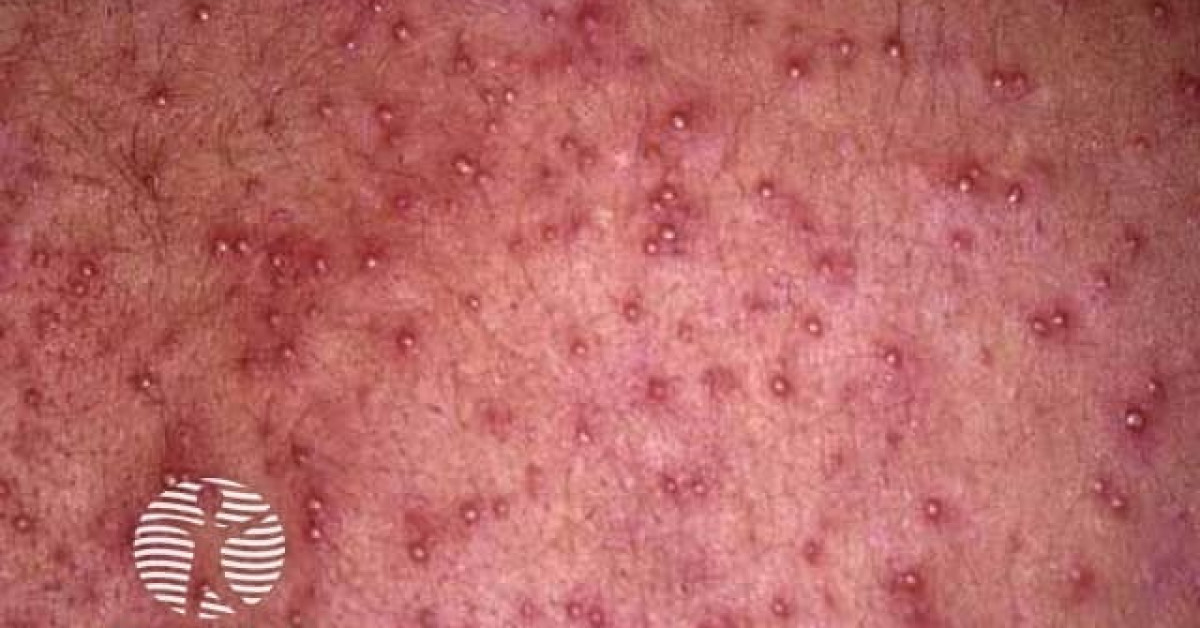 Miliaria pustulosa image