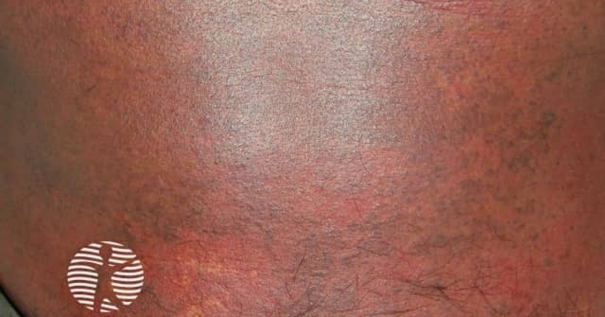 Morbilliform drug eruption image