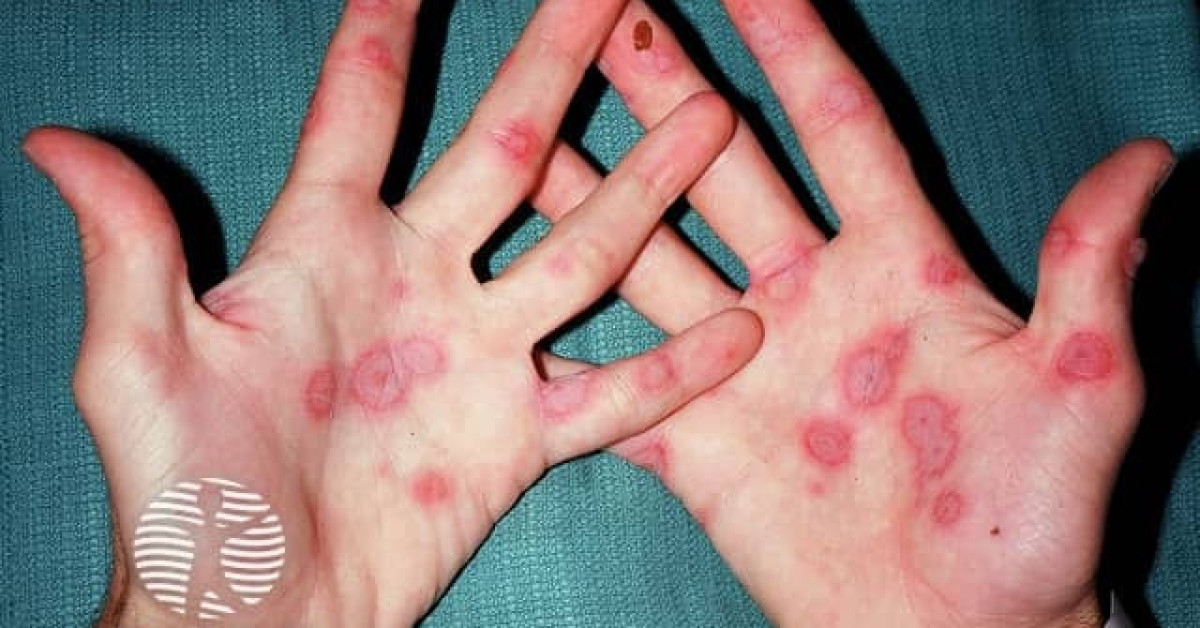 Erythema multiforme image