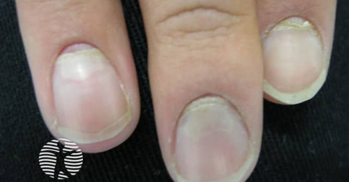 DermNet® - Nail loss after toxic epidermal necrolysis image