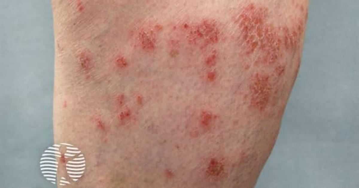 Nummular dermatitis image