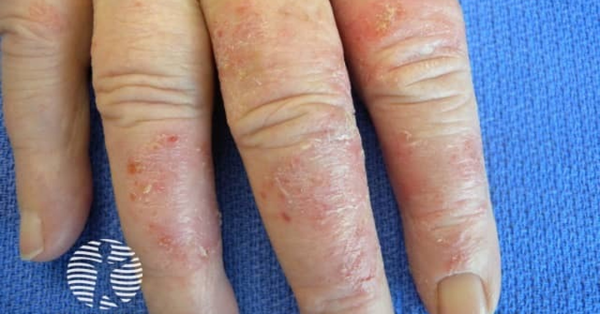 Occupational hand dermatitis image